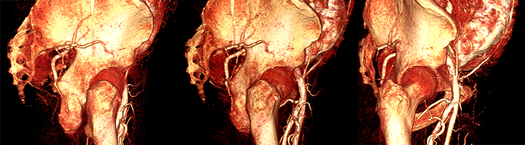 Human Hip Vessels as seen with BriteVu - BriteVu